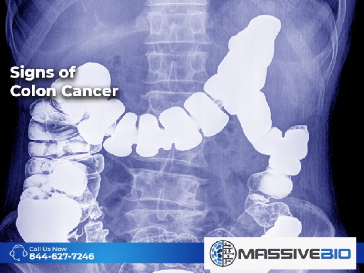 Colonoscopy Symptoms Colon Cancer Symptoms To Look Out For As Illness